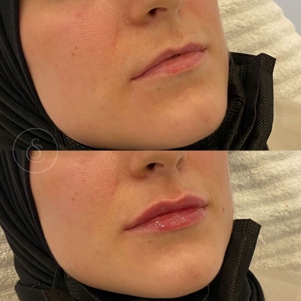 Voor & na foto's & resultaten laserontharing | Fillers Gent