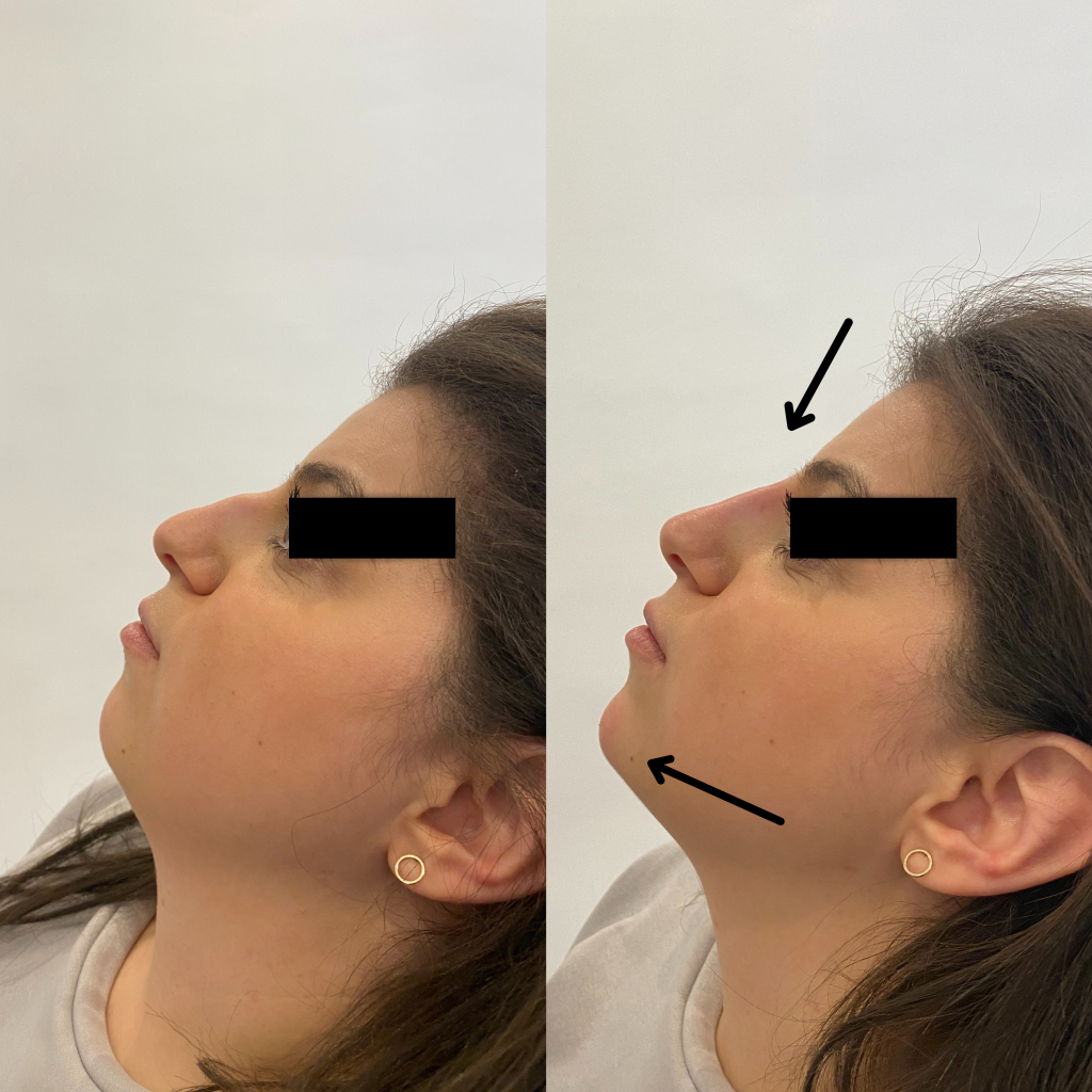 Filler behandeling: alle mogelijkheden op een rij | Sarasin Clinic