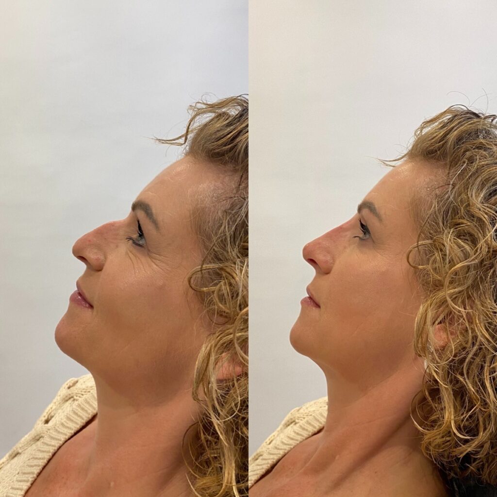 Filler behandeling: alle mogelijkheden op een rij | Sarasin Clinic