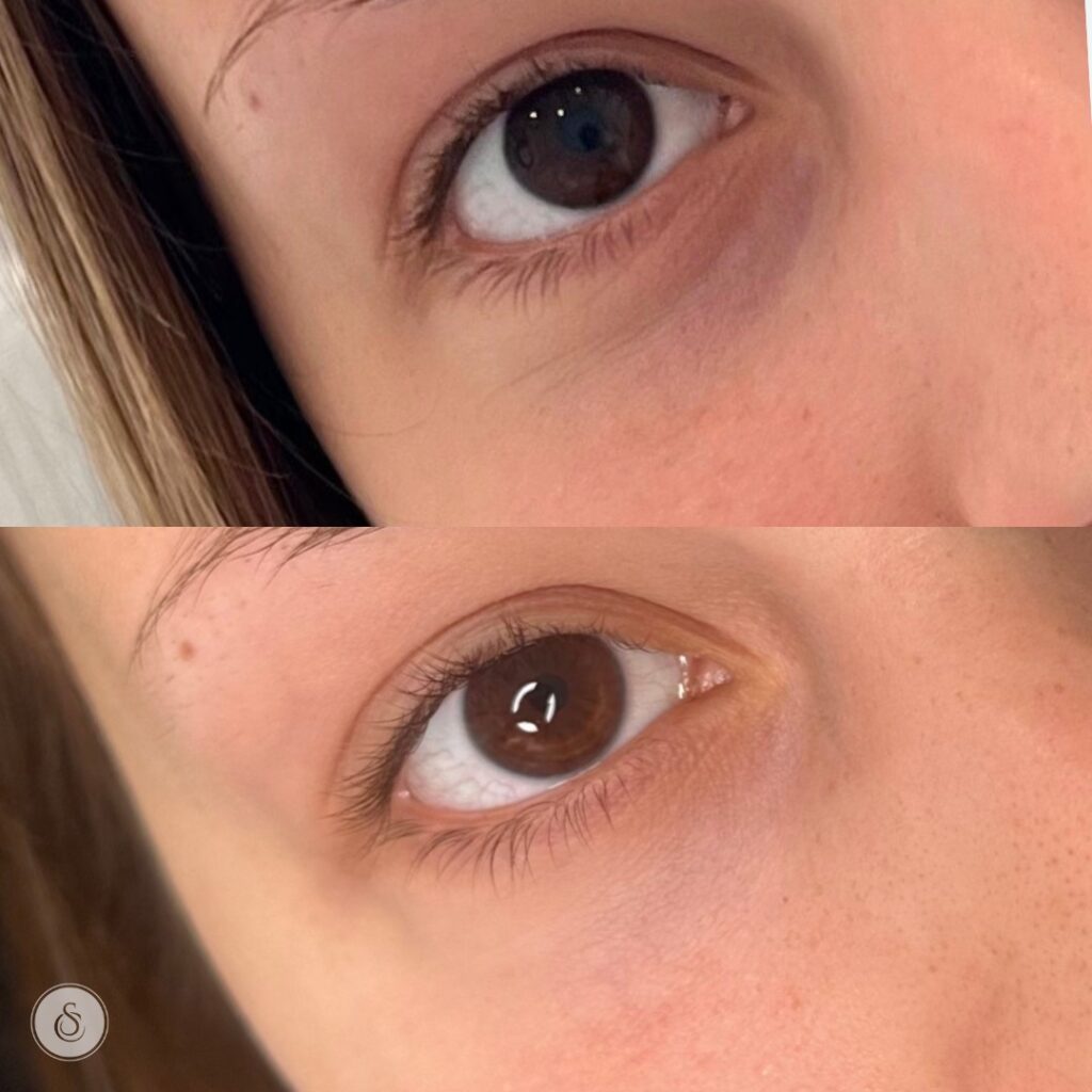 Filler behandeling: alle mogelijkheden op een rij | Sarasin Clinic