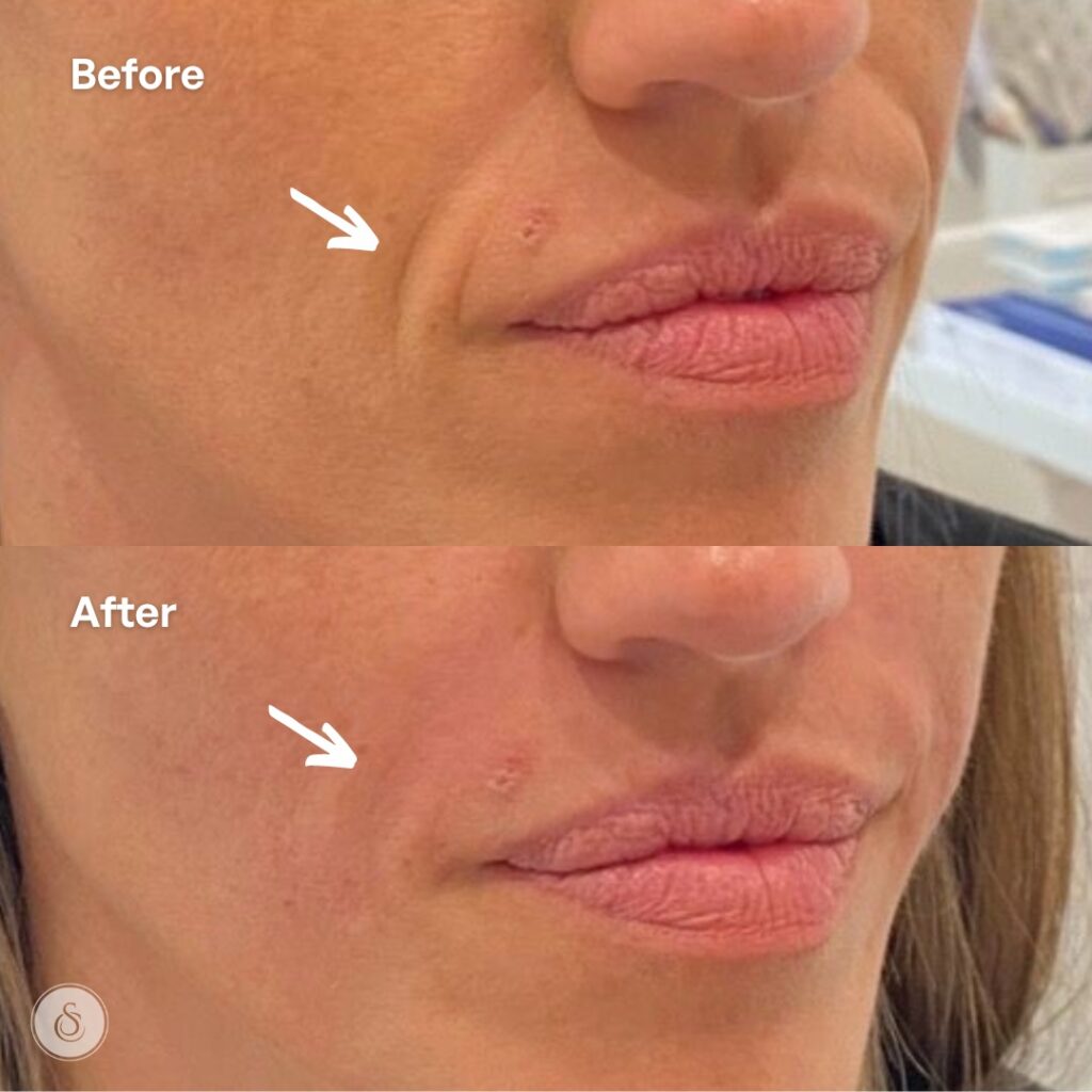 Filler behandeling: alle mogelijkheden op een rij | Sarasin Clinic