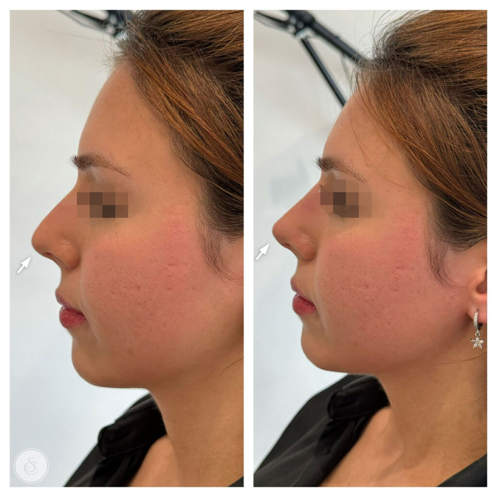 Filler behandeling: alle mogelijkheden op een rij | Sarasin Clinic