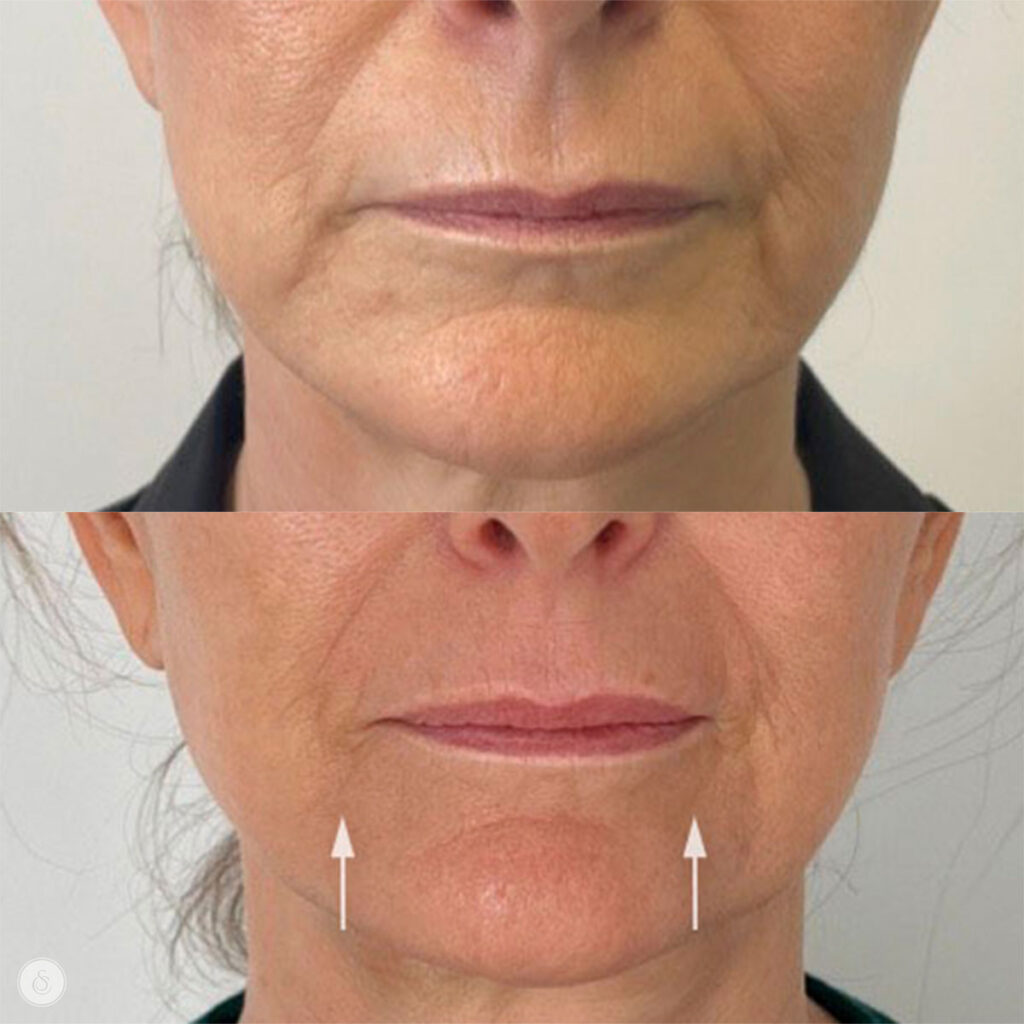 Filler behandeling: alle mogelijkheden op een rij | Sarasin Clinic